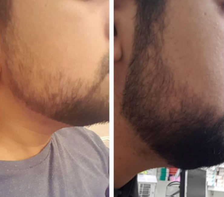 6 Weeks Progress – QS Beauty